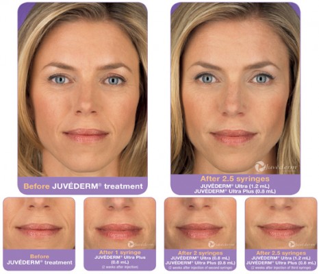 JUVÉDERM® Dermal Filler | Improve facial creases on the lower face ...